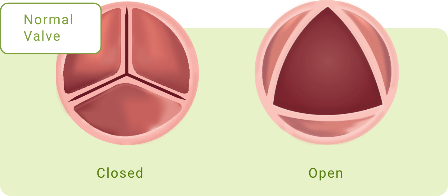 Heart Valve Disease Awareness 2023 - Global Heart Hub
