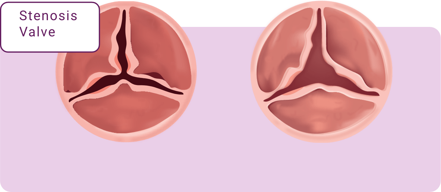 Heart Valve Disease Awareness Week 2022 - Global Heart Hub